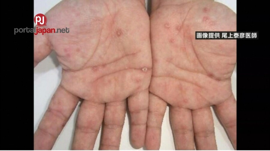 Kaso ng Syphilis sa Japan, nag-tala ng mataas na bilang - Portal Japan